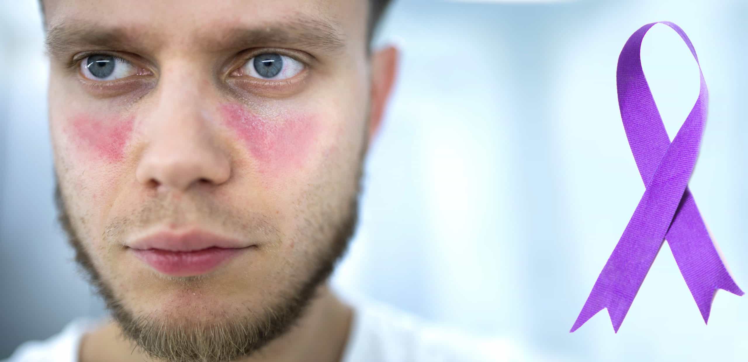 Lupus bolest - simptomi, zaštita, liječenje - Arz.hr