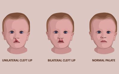 Rascjep nepca Archives - Arz.hr