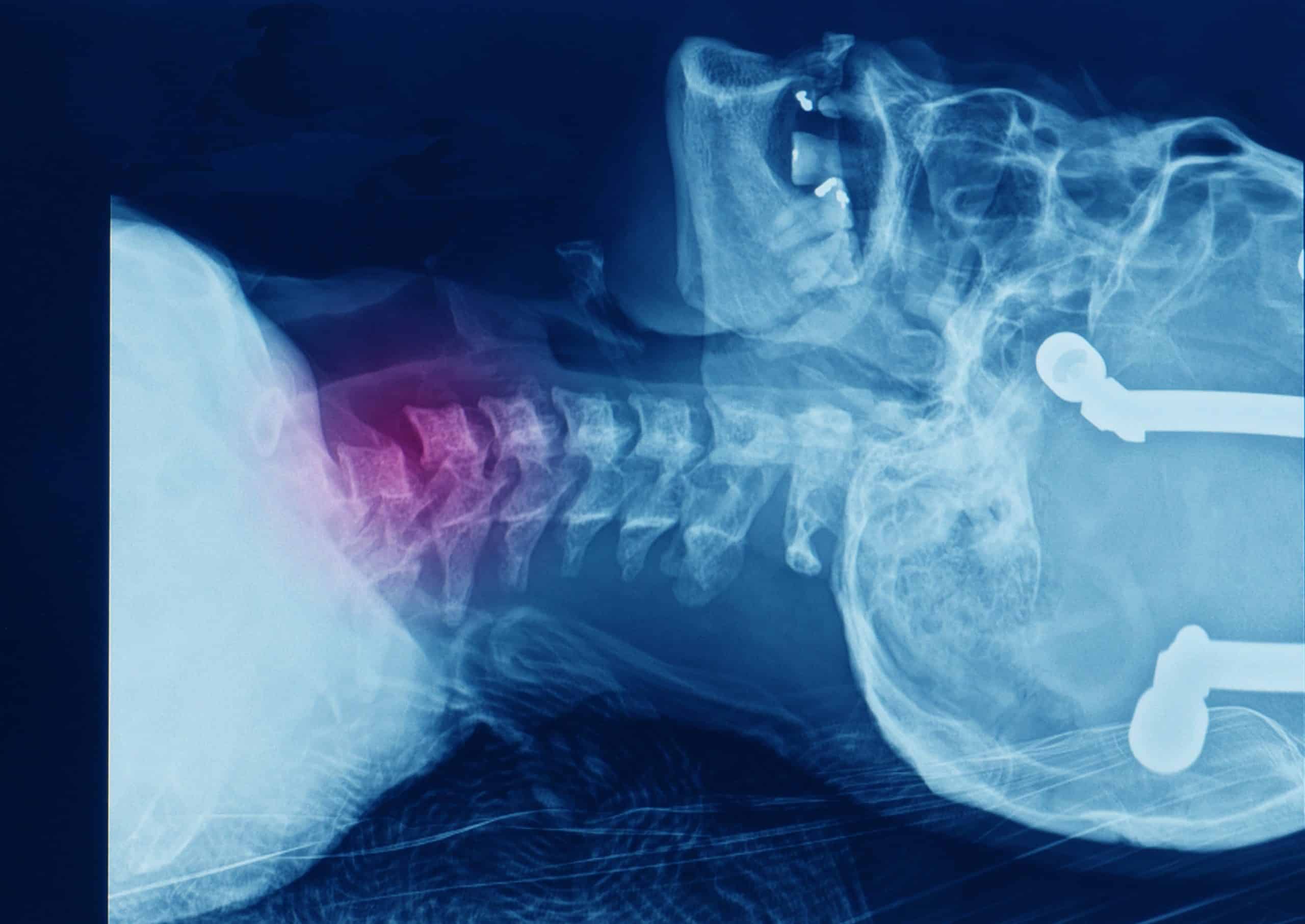 Fasetni zglobovi - bolovi, blokada, upala - Arz.hr
