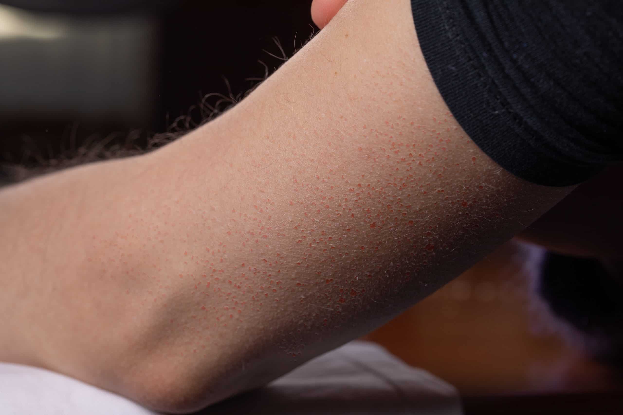 Keratosis pilaris ili pureća koža - uzrok, simptomi i liječenje - Arz.hr