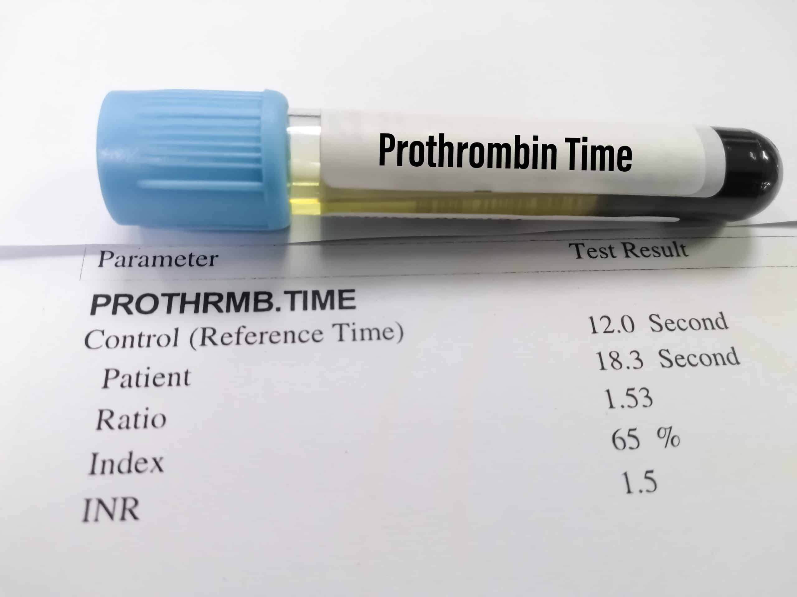 Protrombinsko vrijeme - što je i kako se izvodi test - Arz.hr