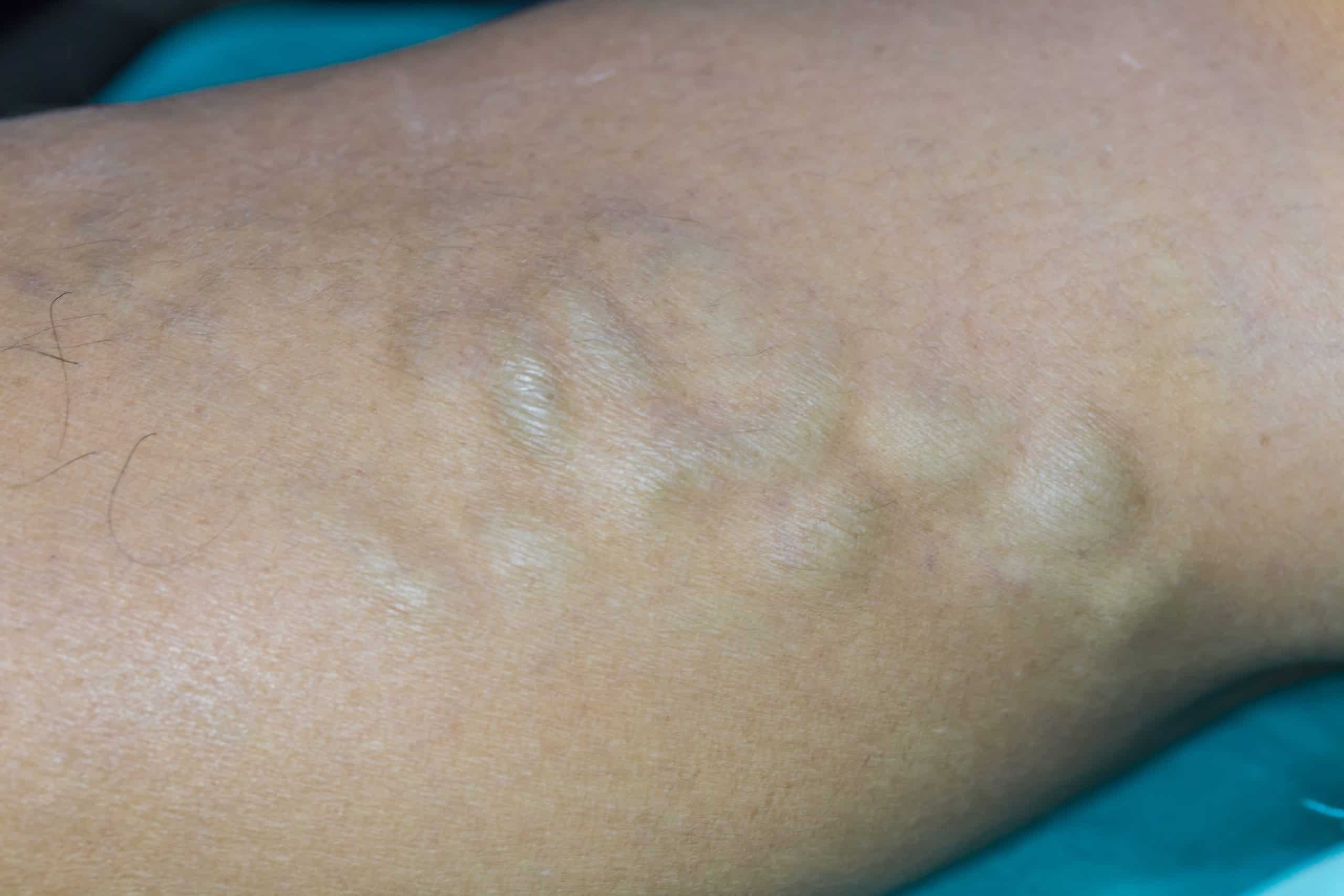 Ispupčene vene na nogama - uzrok, simptomi, liječenje - Arz.hr