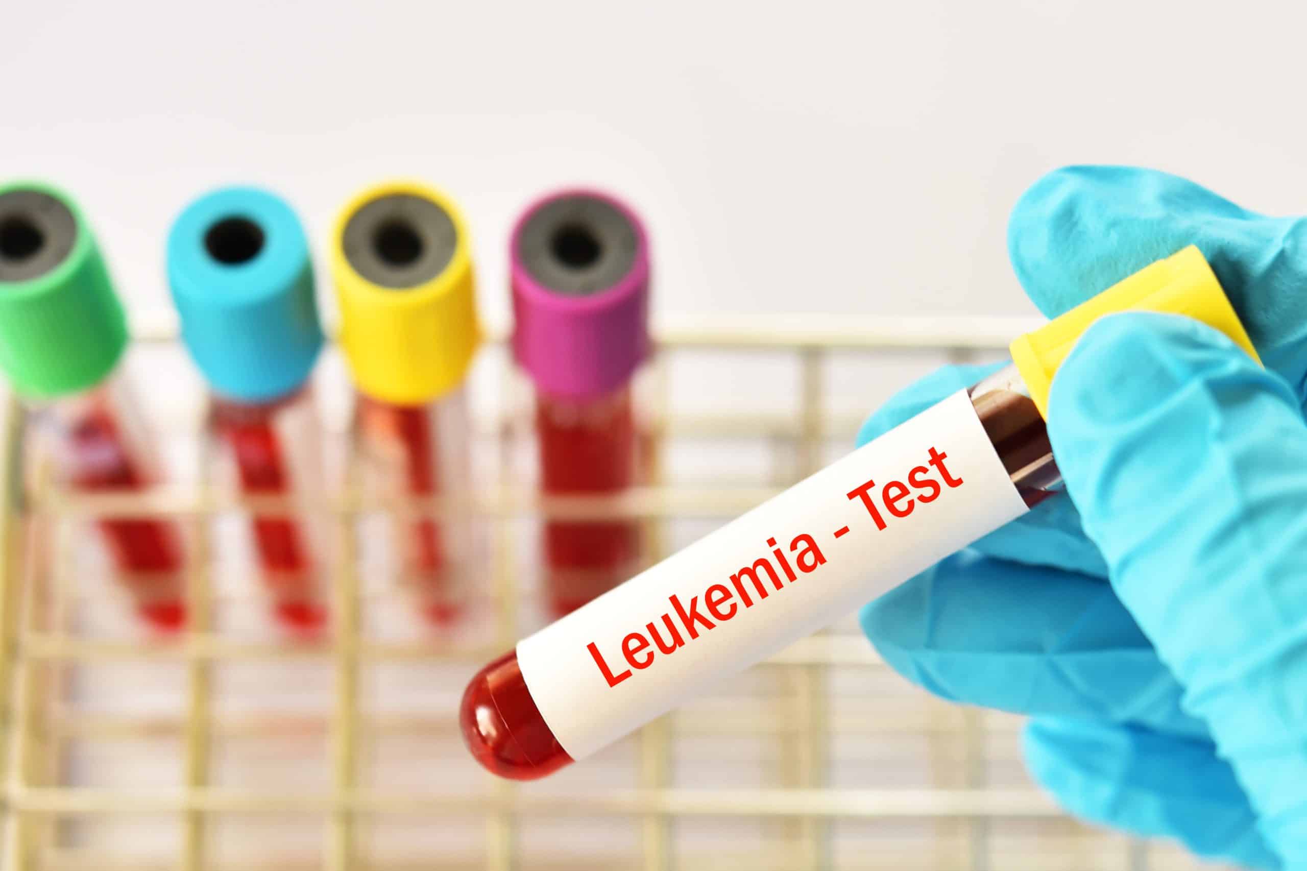 Kronična limfocitna leukemija - uzrok, simptomi, liječenje - Arz.hr