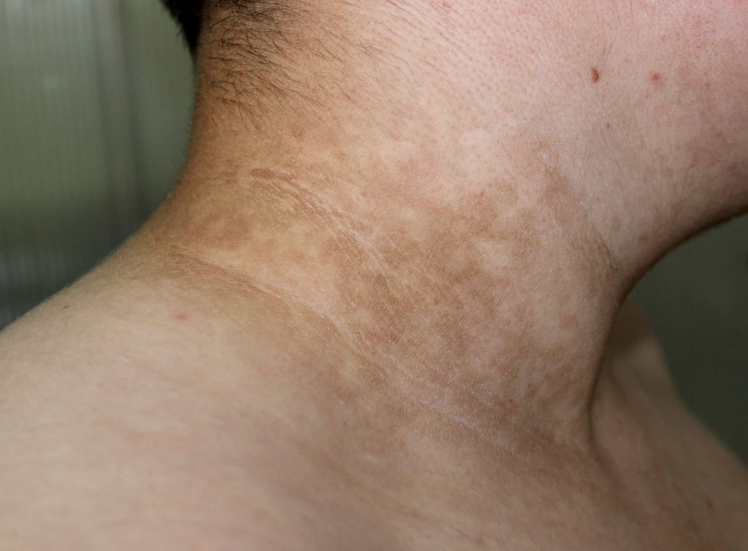 Crna akantoza (acanthosis nigricans) - uzrok, simptomi, liječenje - Arz.hr