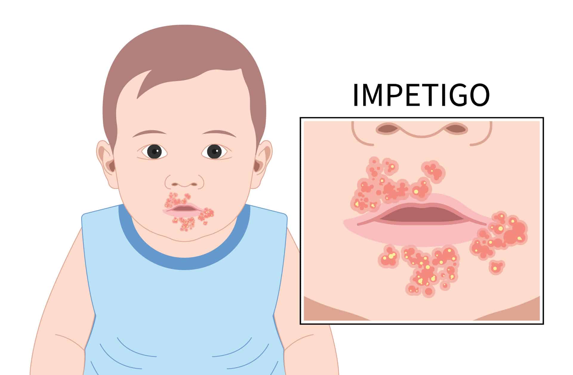 Impetigo contagiosa - uzrok, simptomi, liječenje - Arz.hr