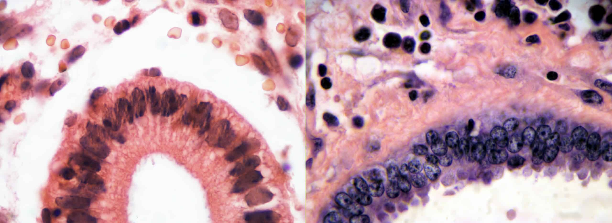 Sarkom maternice - uzrok, simptomi, liječenje - Arz.hr