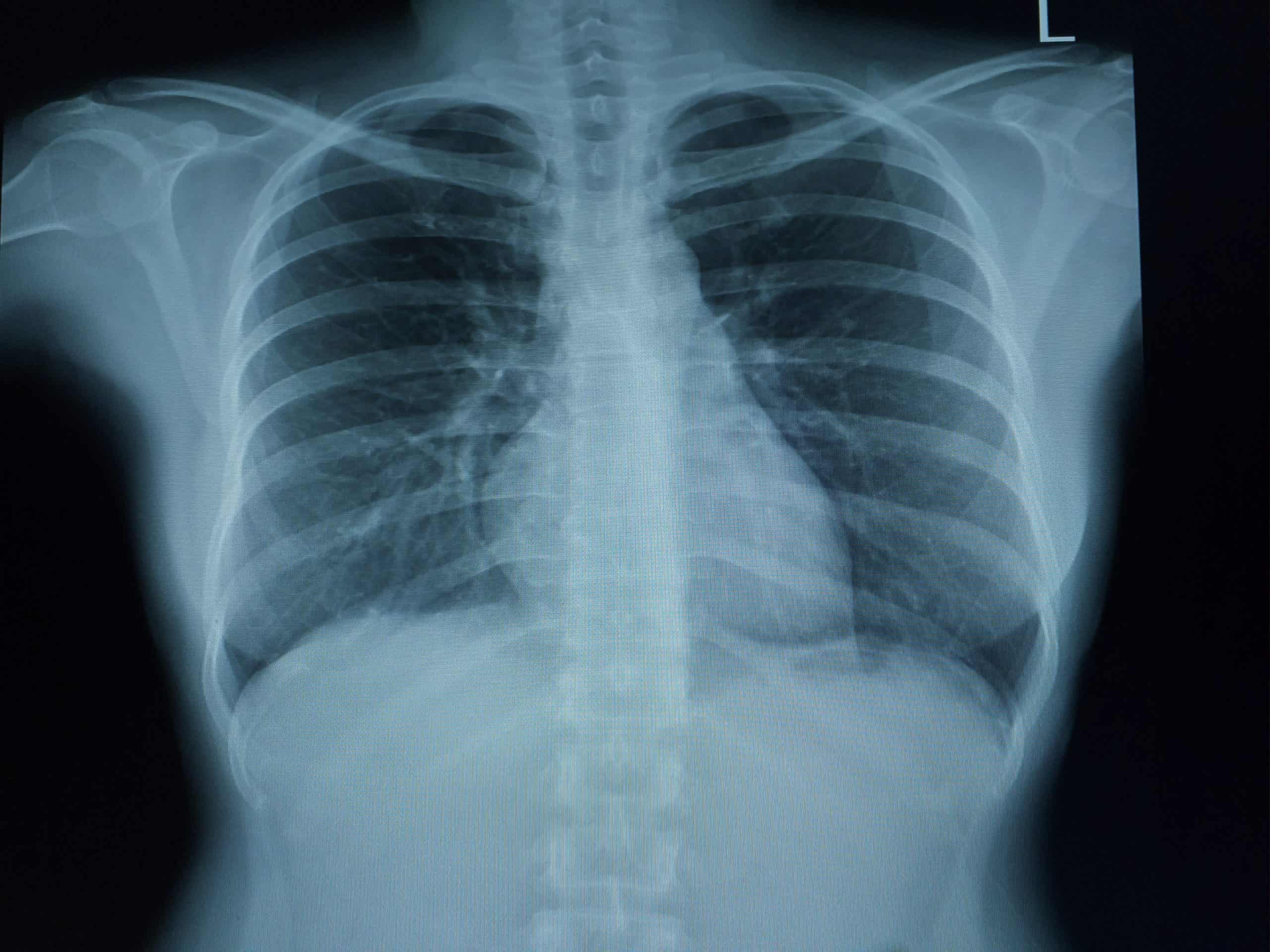 Slomljena rebra - uzrok, simptomi, liječenje - Arz.hr
