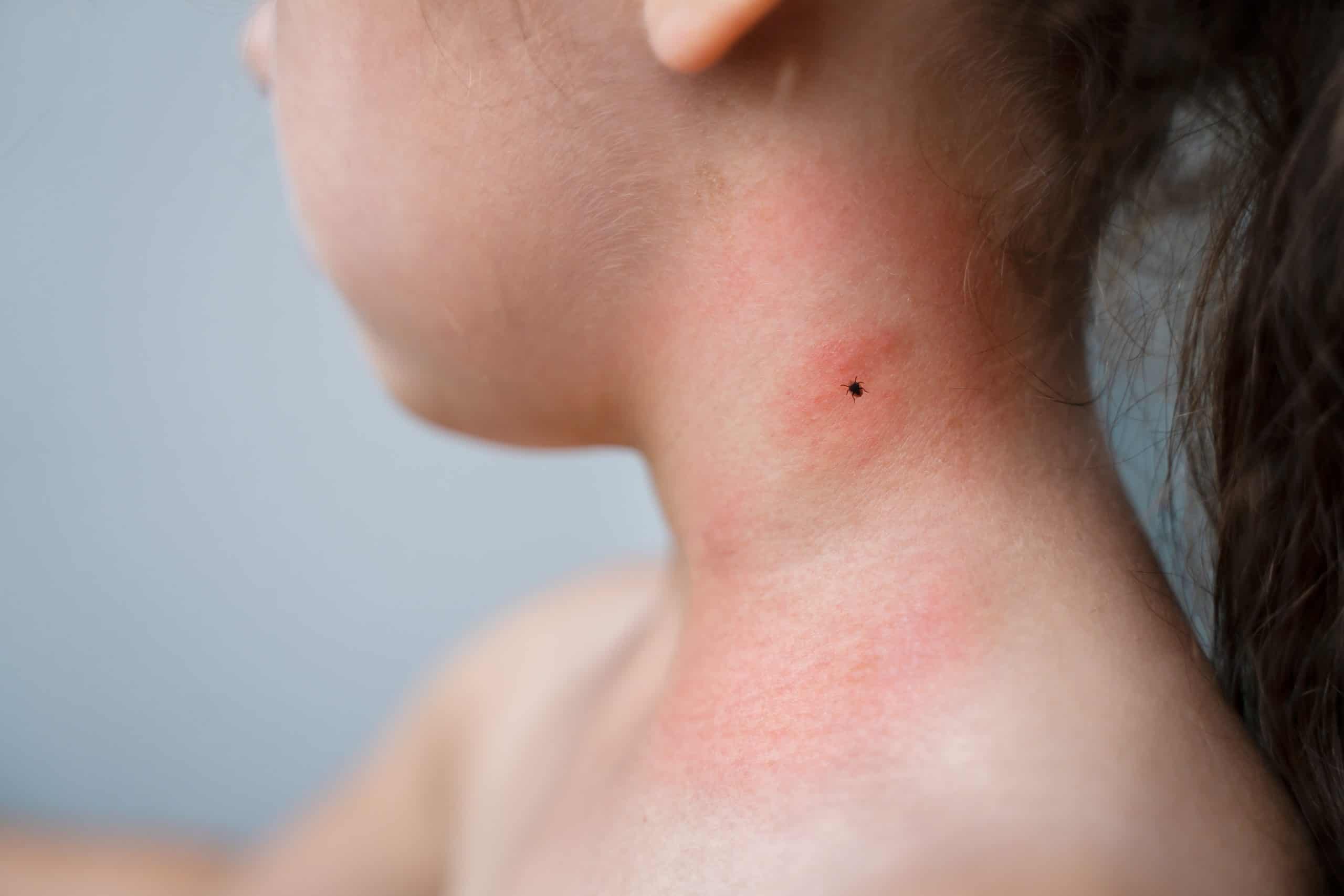 Što je borelioza - Arz.hr