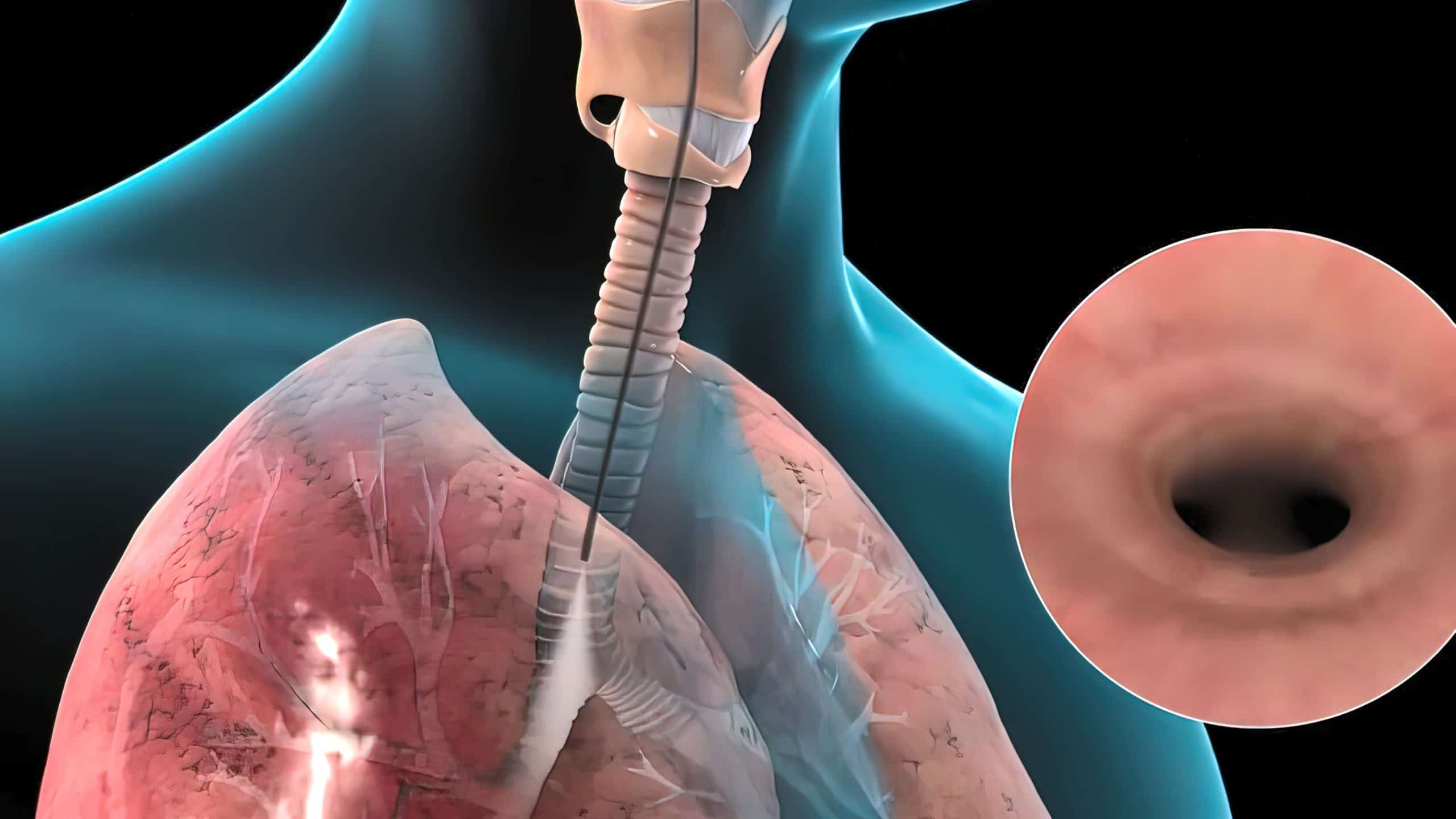 Što je bronhoskopija - Arz.hr