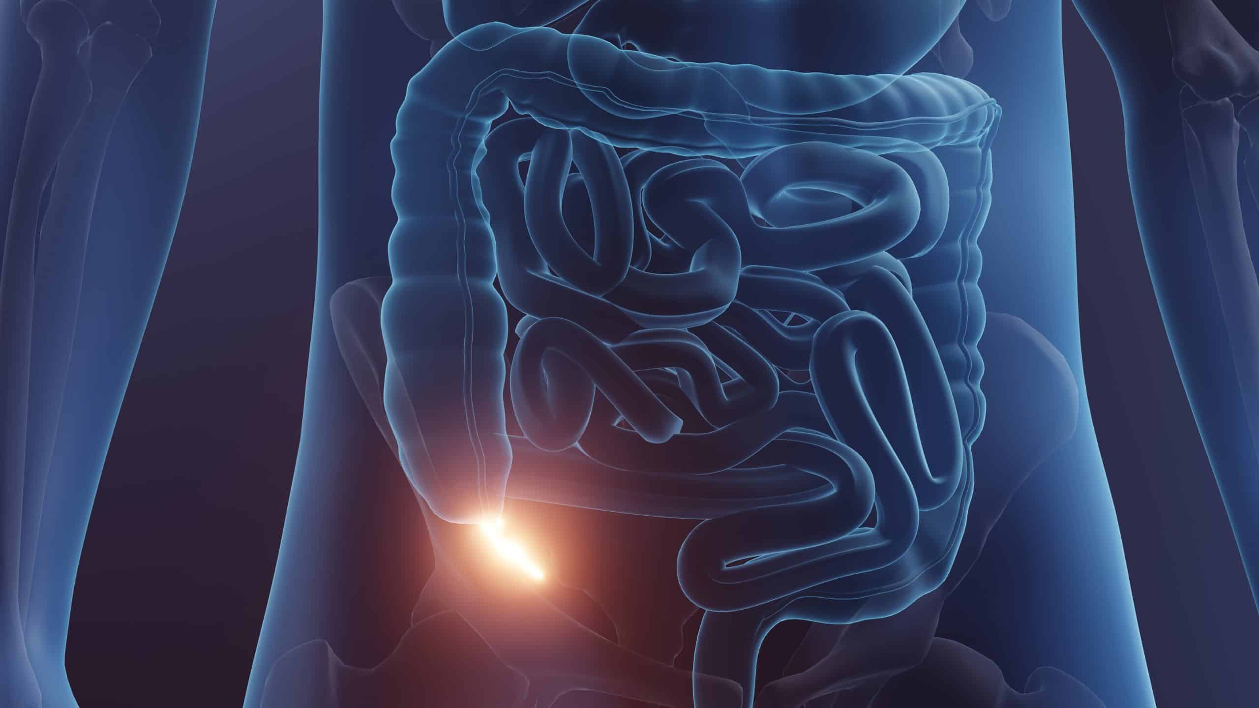 Što je crvuljak - Arz.hr