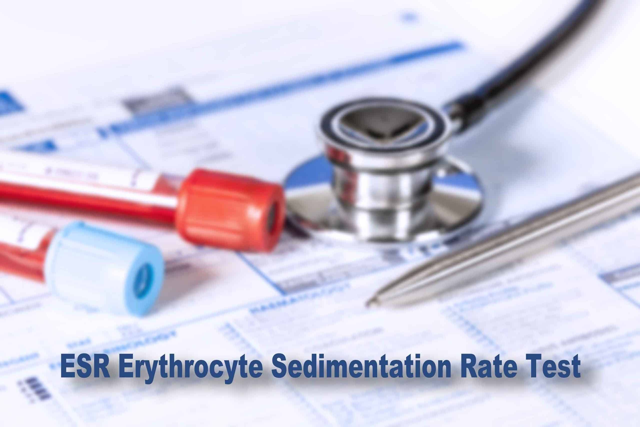 Što je esr (erythrocyte sedimentation rate) - Arz.hr