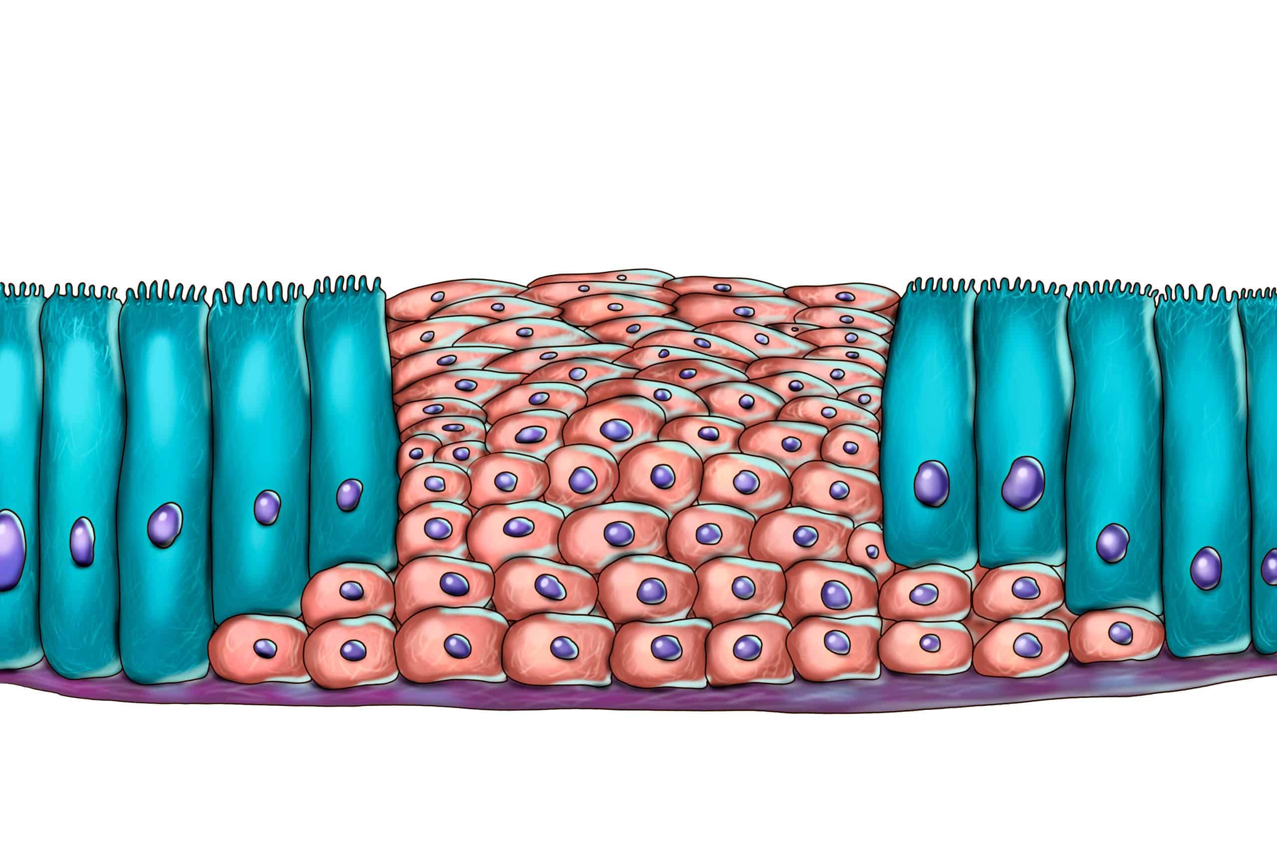 Što je metaplazija - Arz.hr