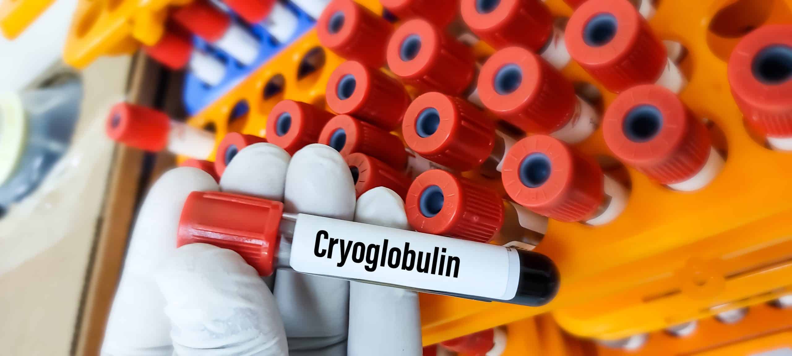 Što su krioglobulini - Arz.hr