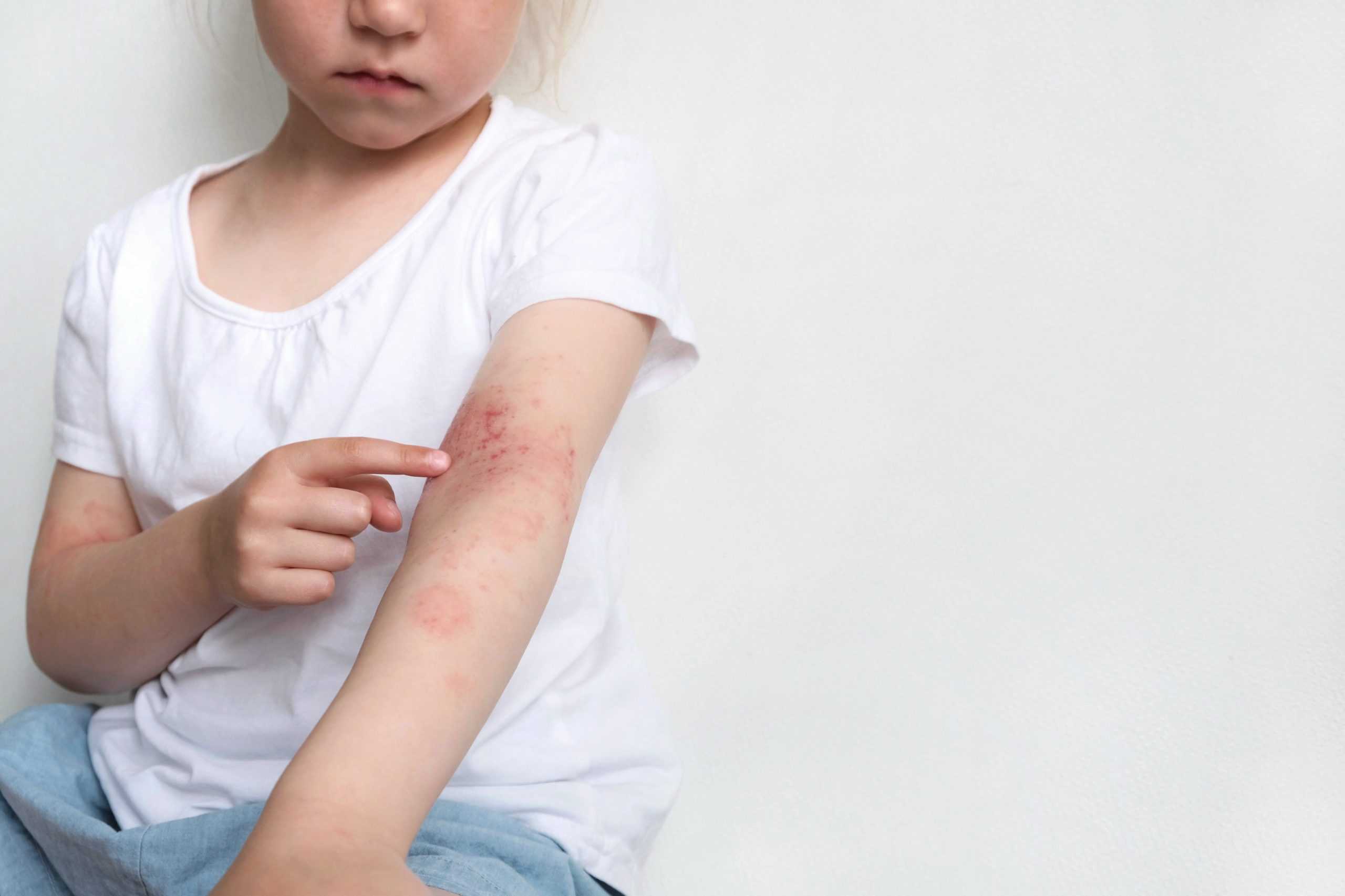Što je dermatitis - Arz.hr
