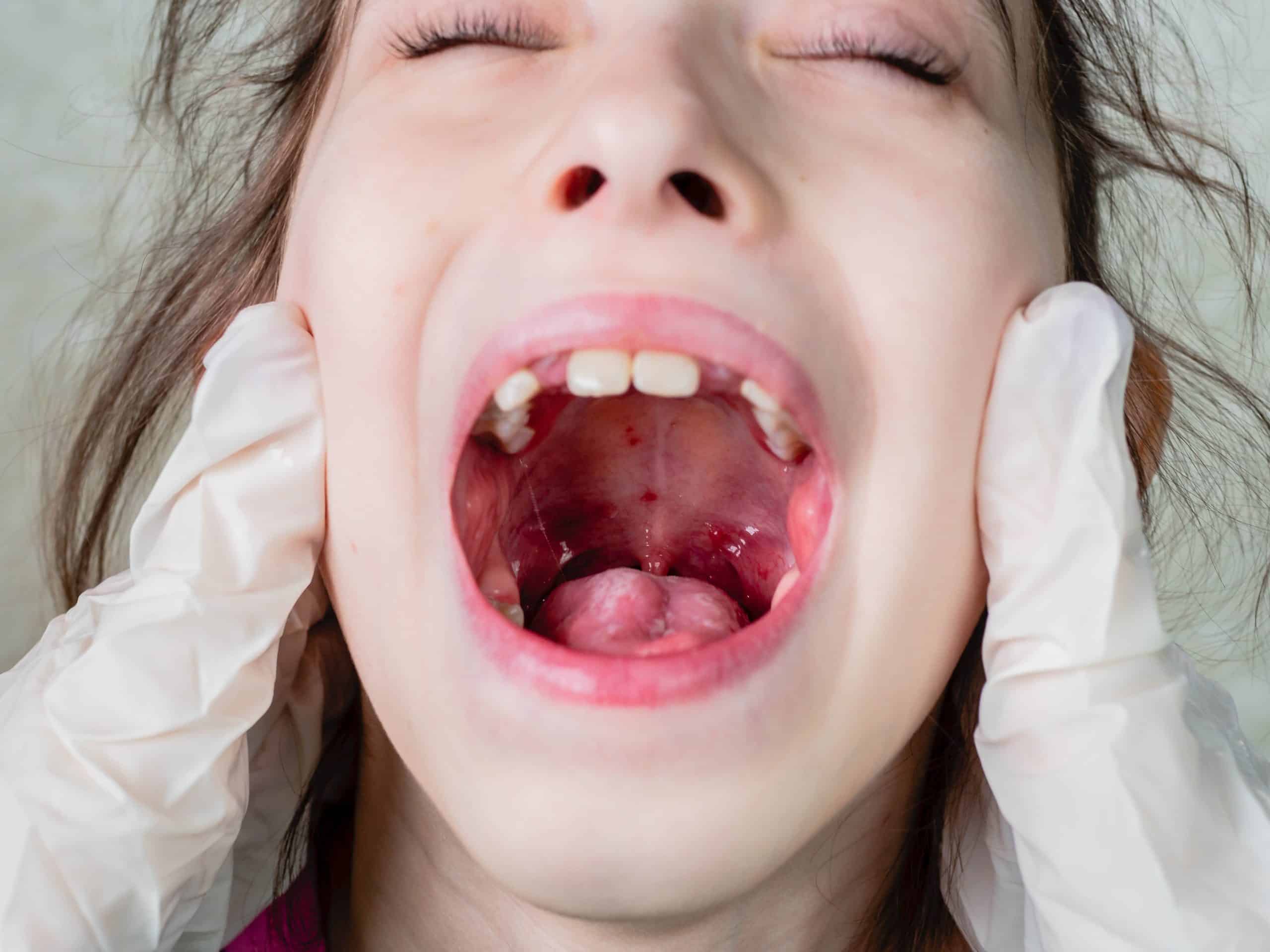 Gnojna angina - uzrok, simptomi, liječenje - Arz.hr