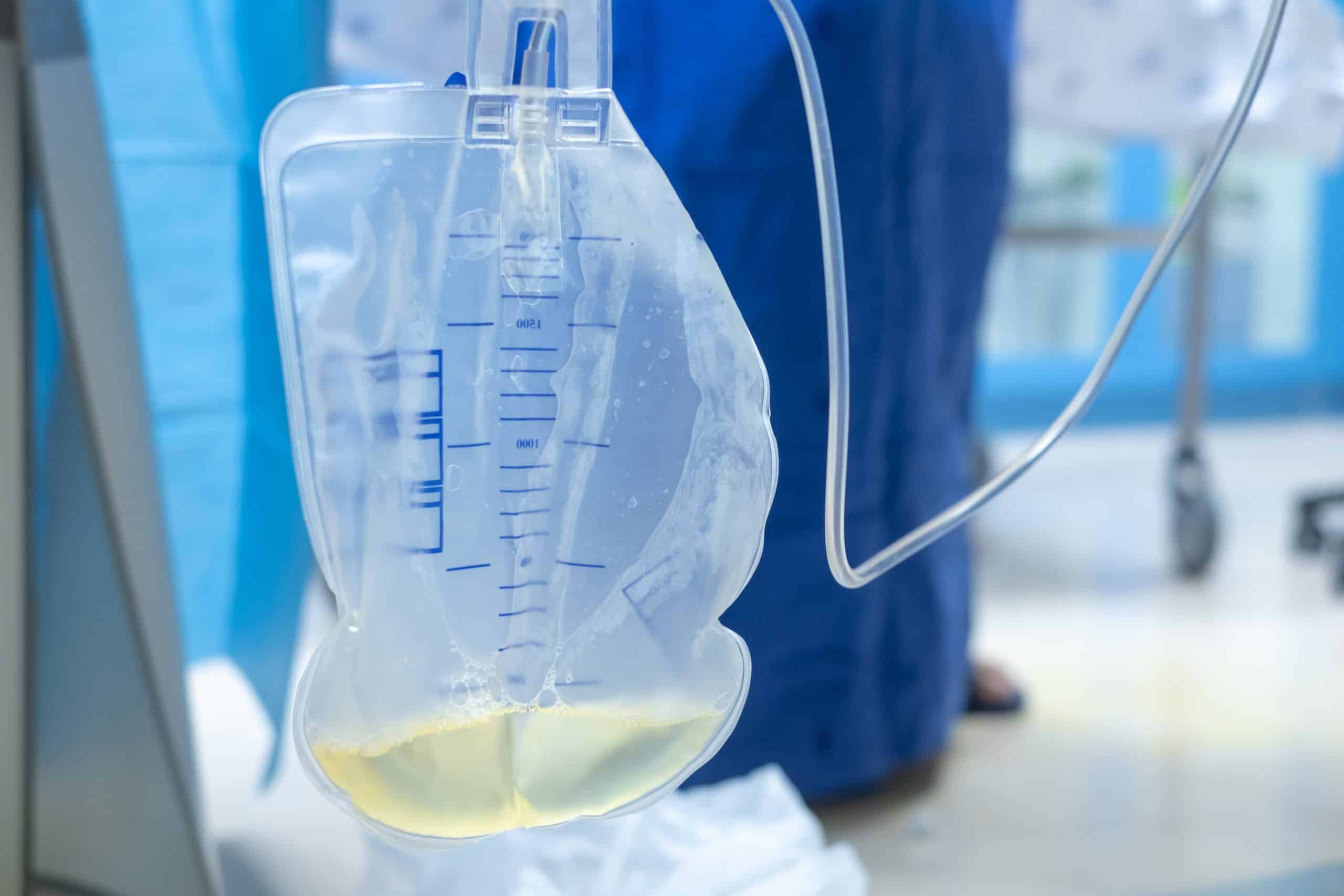 Kada se vadi dren nakon operacije - Arz.hr