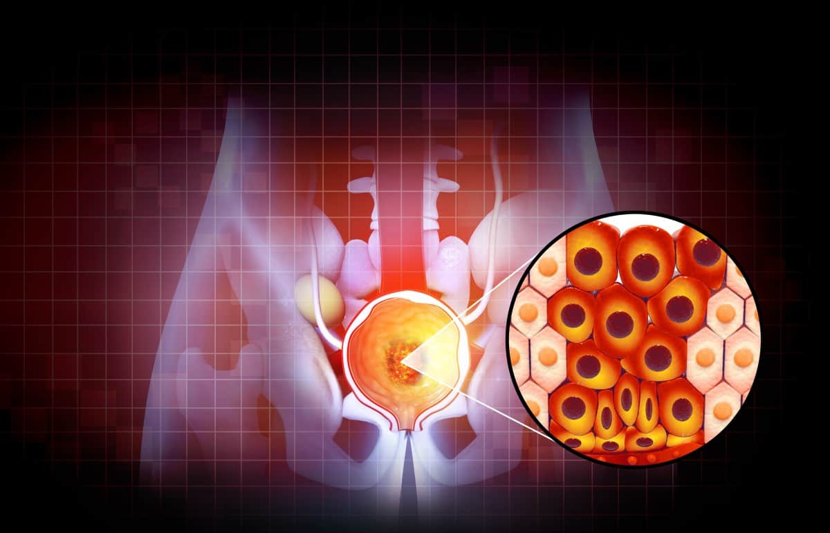 Biopsija prostate kako se radi - Arz.hr